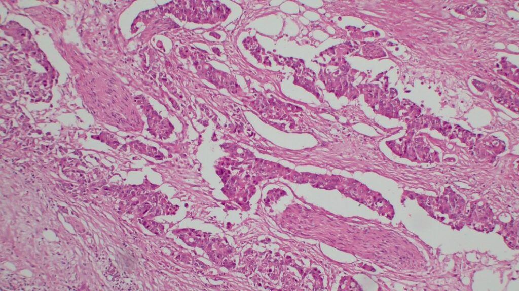 Diagnostic Image: Perineural infiltration - Kauvery Hospital