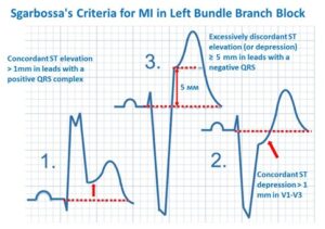 Sgarbossa criteria for AMI with LBBB (Left Bundle Branch Block ...