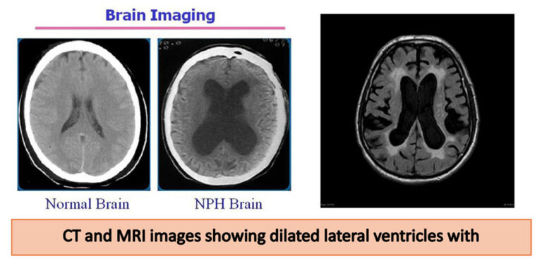 Normal Pressure Hydrocephalus (NPH) | Types & Symptoms | Diagnosis ...