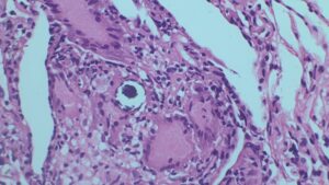 Diagnostic Images: Schaumann Bodies - Kauvery Hospital