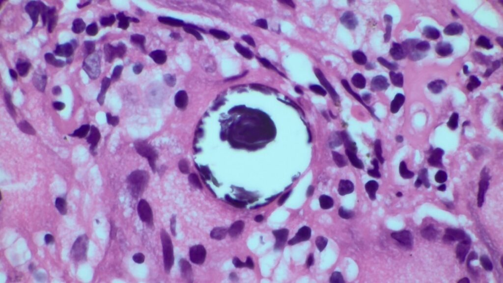 Diagnostic Images: Schaumann Bodies - Kauvery Hospital