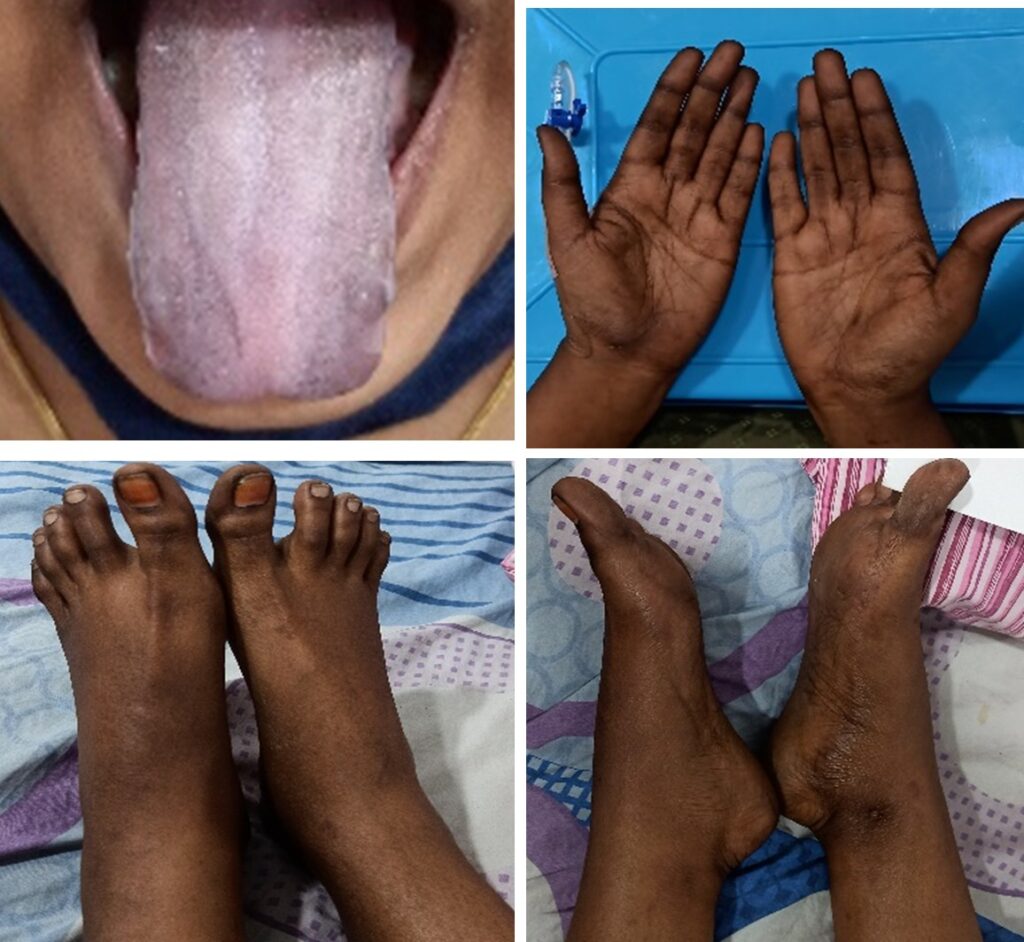 When vitamin B12 deficiency strikes early: A case of pernicious anemia with neurological ...