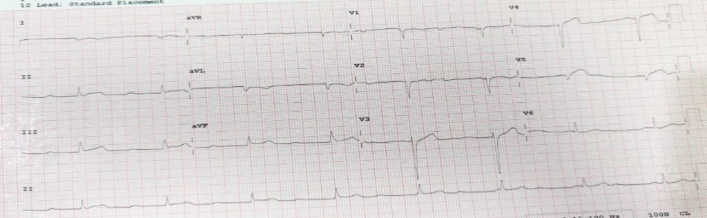 Complete heart block: A rare complication in anterior wall MI - Kauvery ...