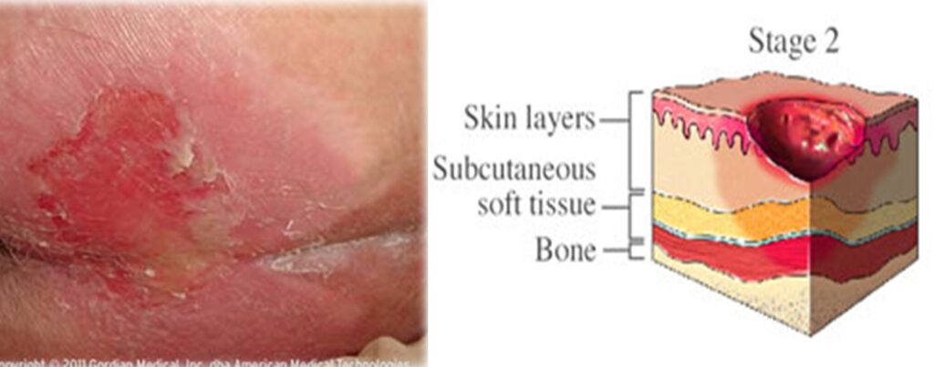 CNE on Pressure Injury Prevention | Kauvery Hospital Nursing Education