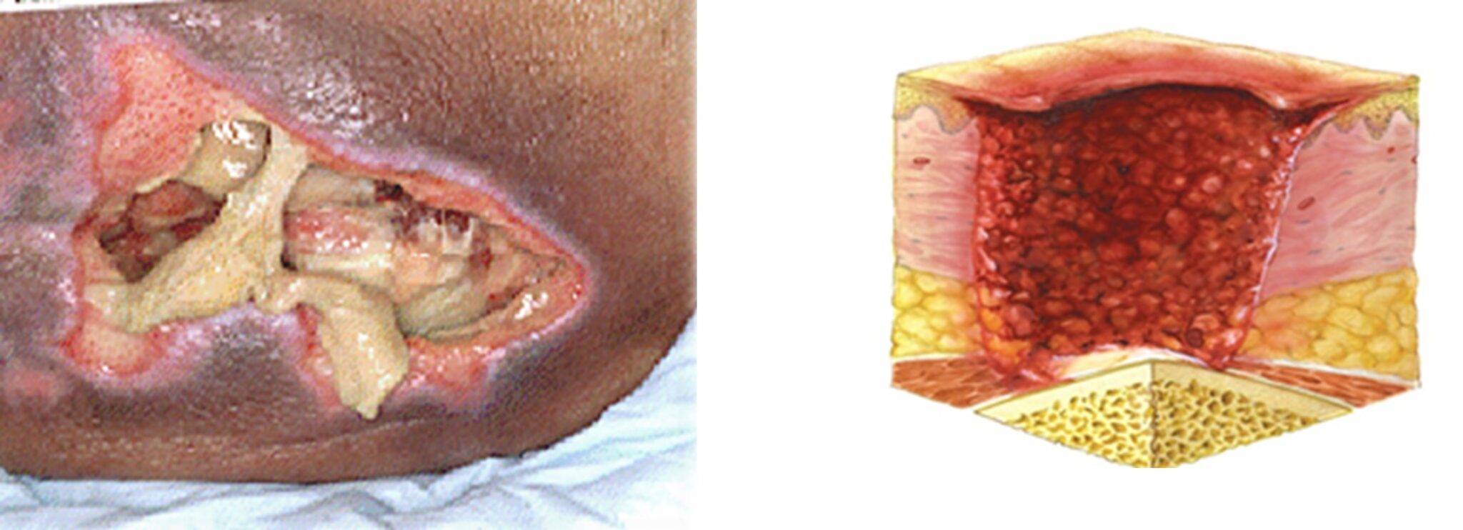 CNE on Pressure Injury Prevention | Kauvery Hospital Nursing Education