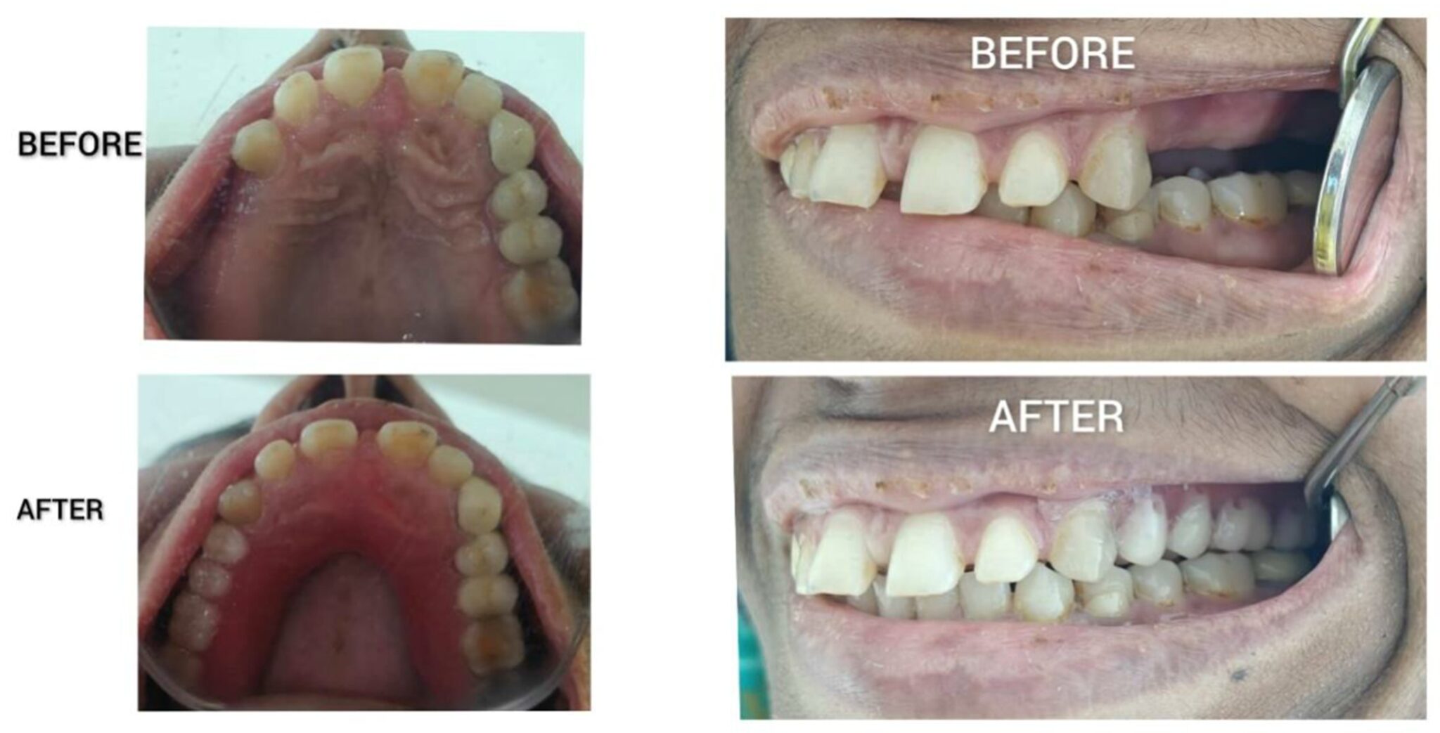 Beyond traditional dentures: Innovative solutions for comfort and ...