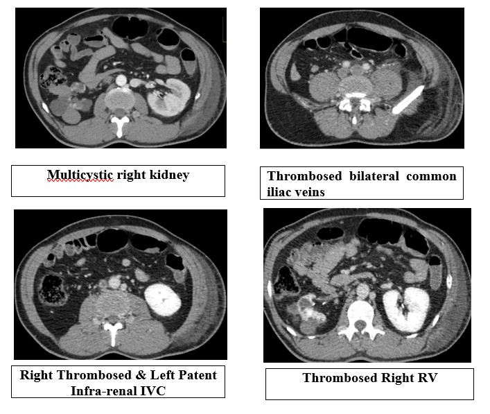Duplication of inferior vena cava with an interrupted segment and DVT ...