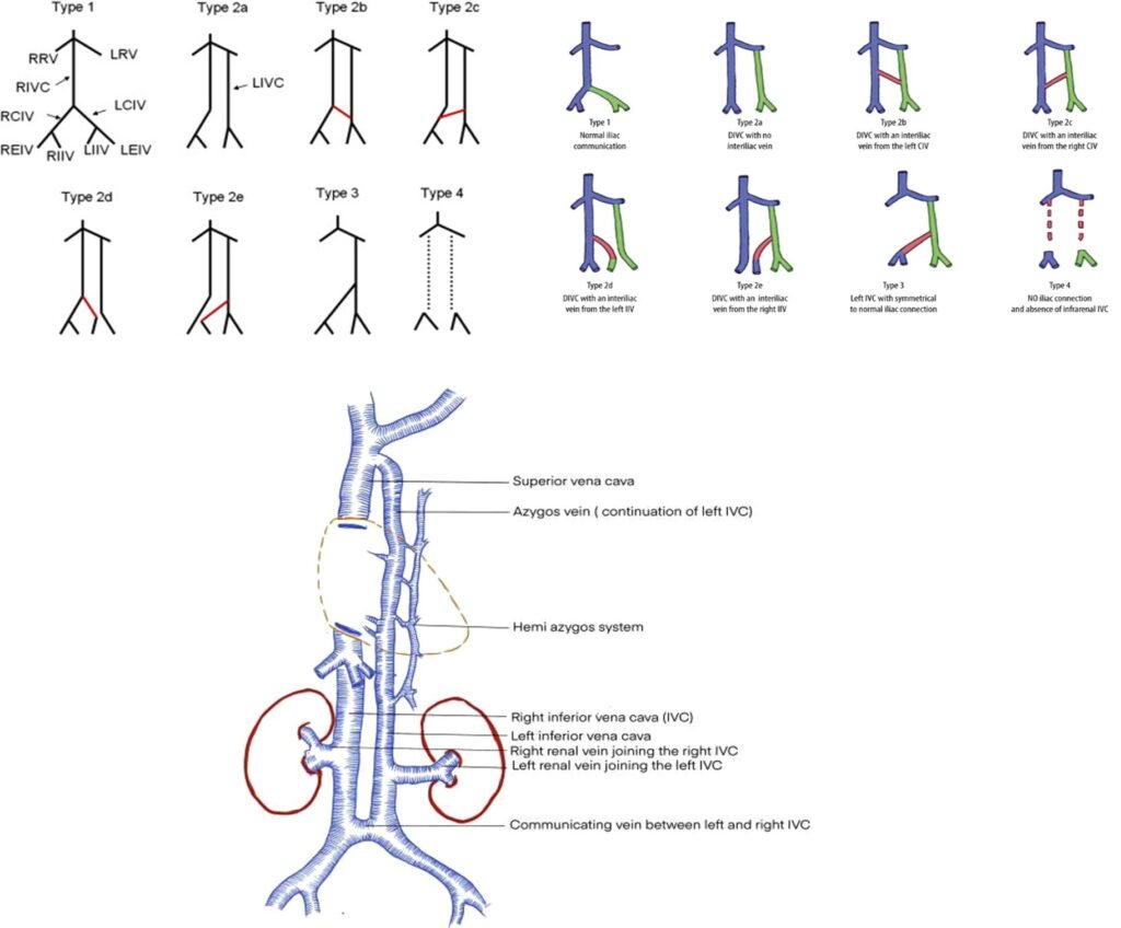 Duplication of inferior vena cava with an interrupted segment and DVT ...