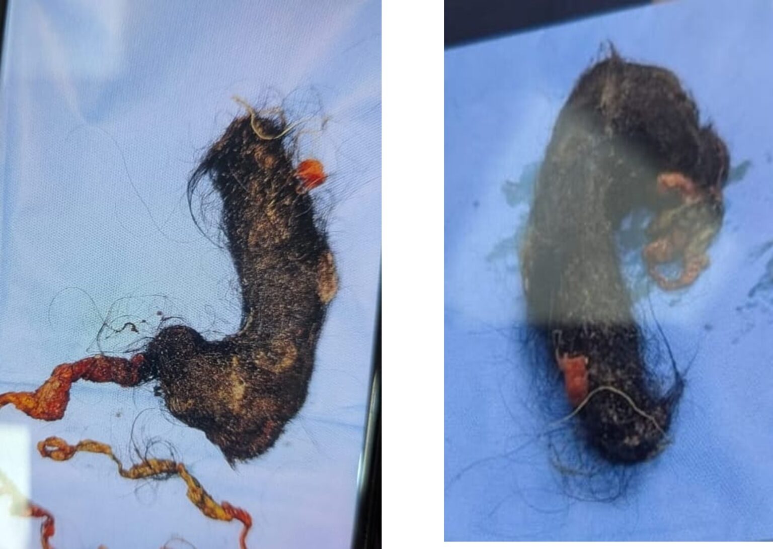 A case report on laparoscopic retrieval of a massive gastric ...