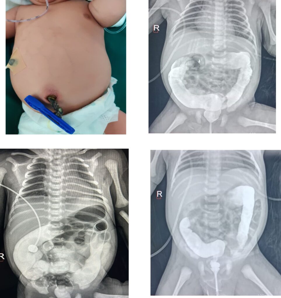 A complex neonatal presentation requiring Ladd’s procedure: A case ...