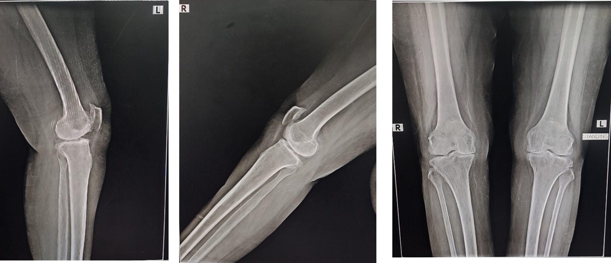 Pioneering the future: The first step in robotic surgery - Kauvery Hospital