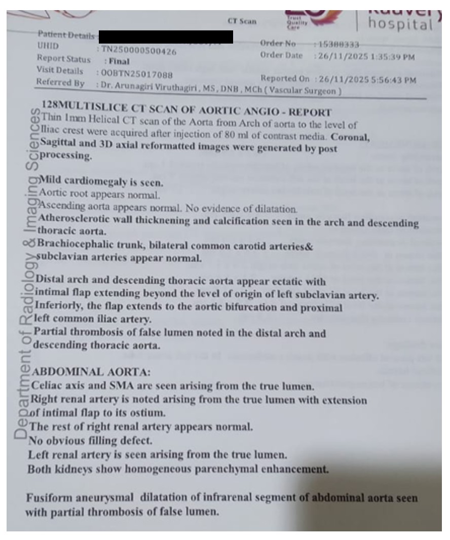 Type B Thoracoabdominal Aortic Dissection (TBAD) with fusiform aneurysm ...