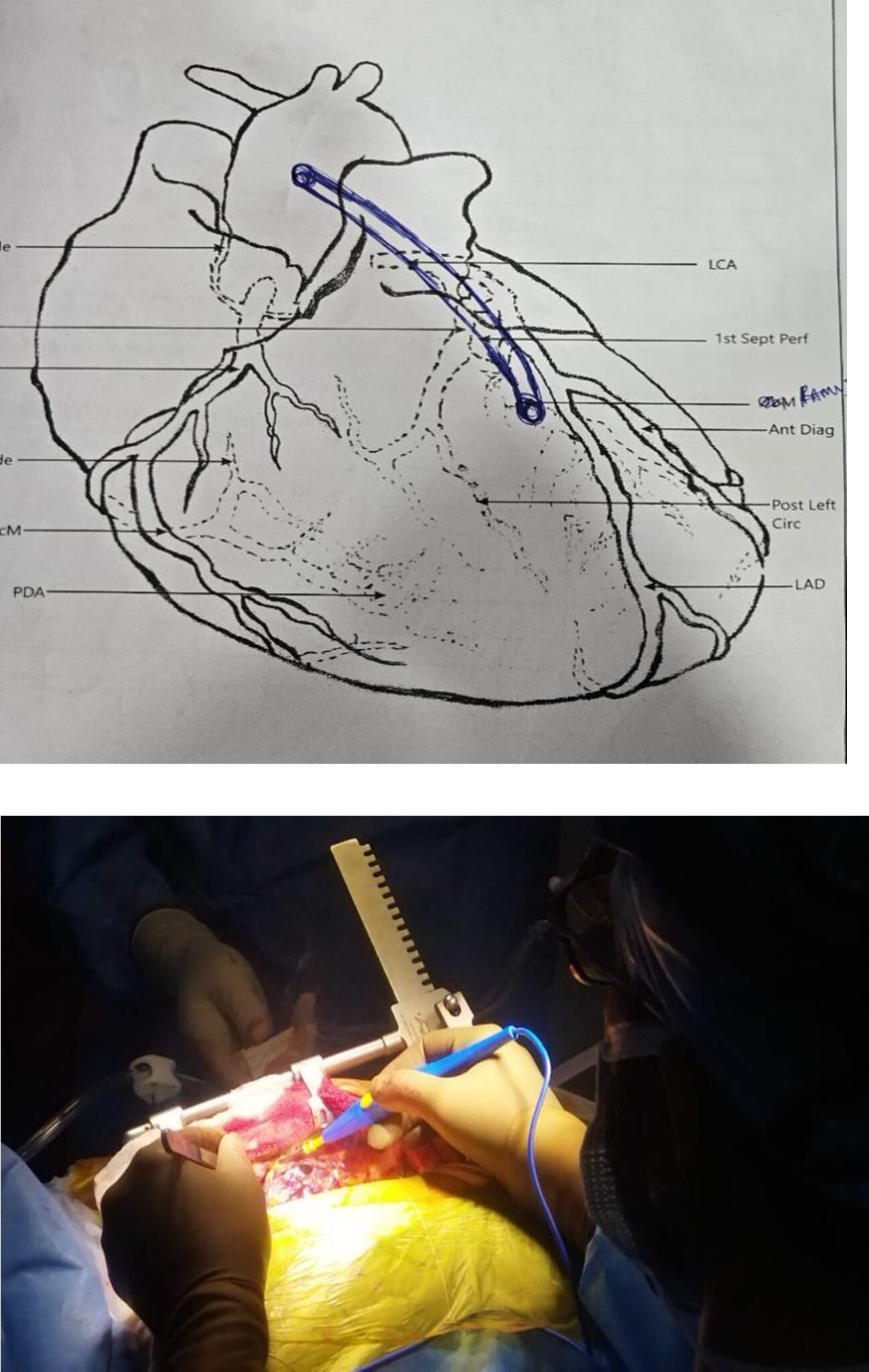 Dual surgical intervention in cardiac disease: A case study on CABG ...