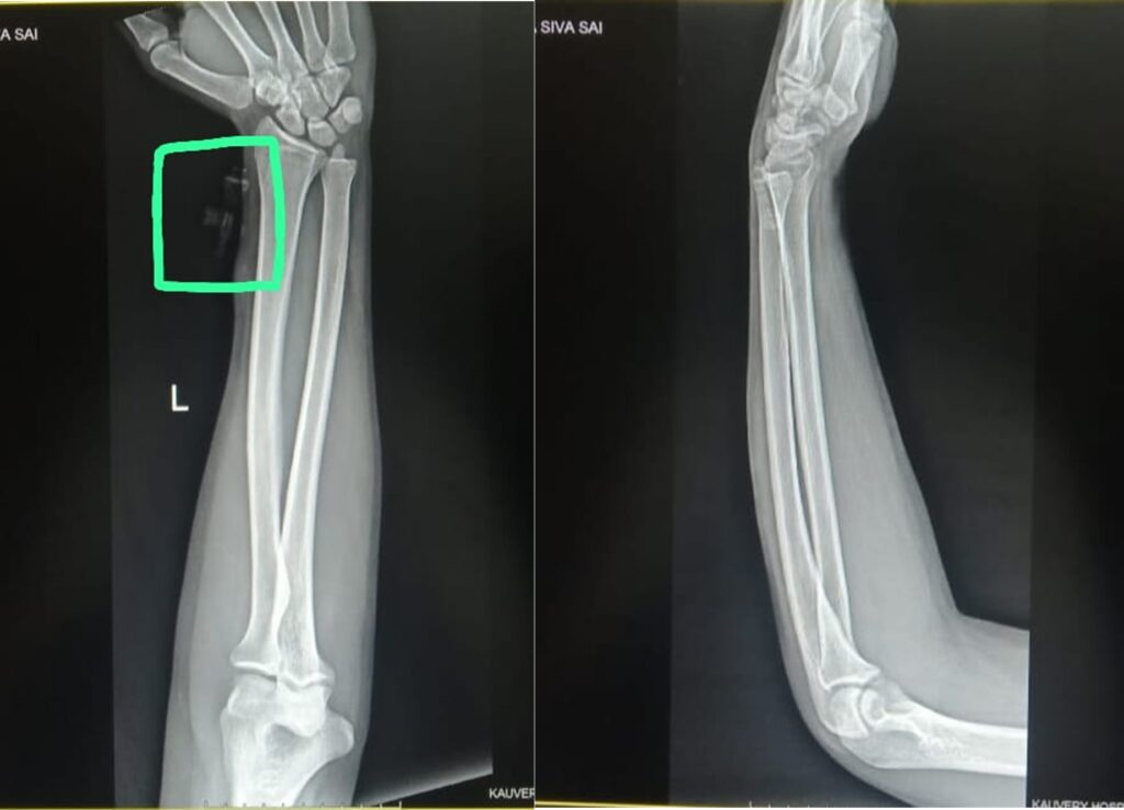 A case report on surgical retrieval of fragmented intravenous cannula ...