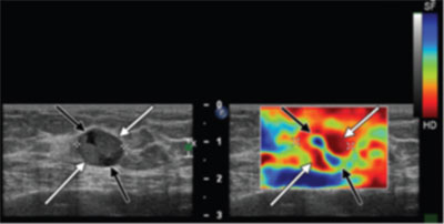 What Is Liver Elastography? – Types, Benefits, Limitations