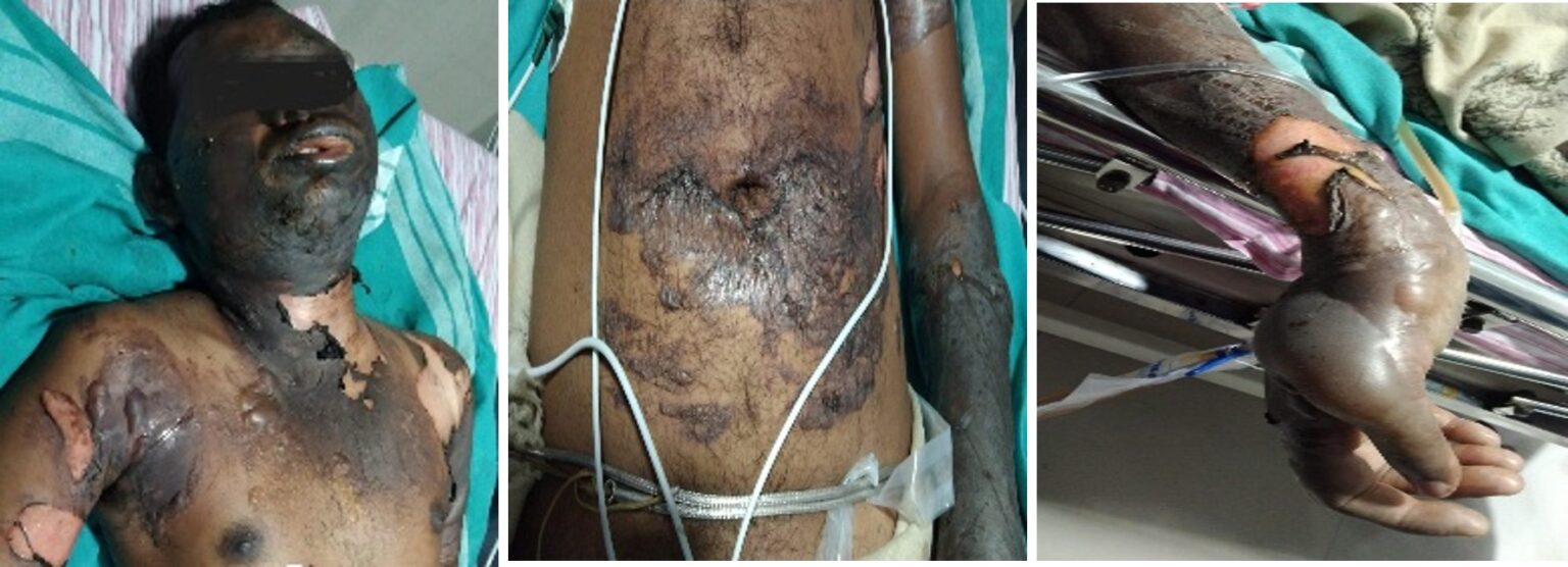 Flash fire injuries: A preventable catastrophe - Kauvery Hospital