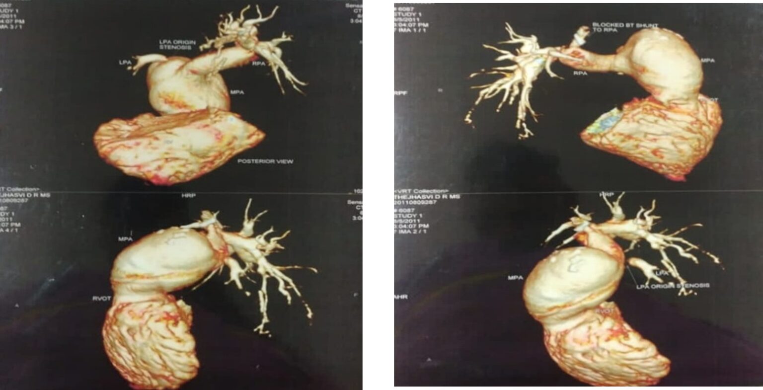 Left pulmonary artery stent restenosis in a patient with repaired ...
